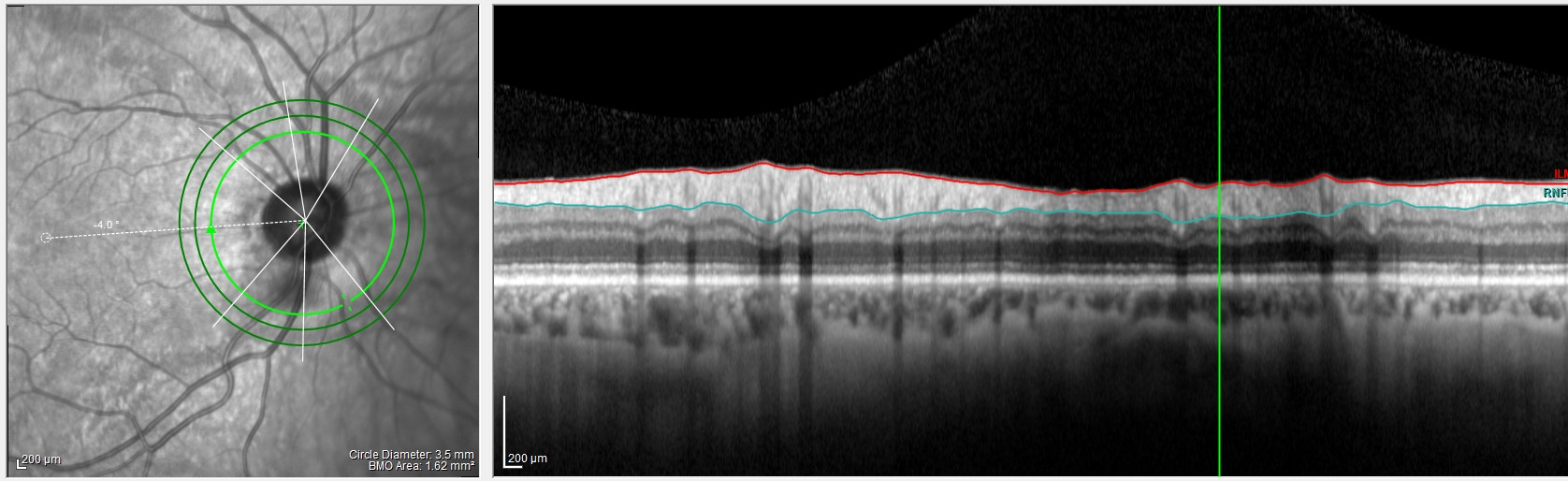 Glaucoma - Progression | Hood Visual Science Lab